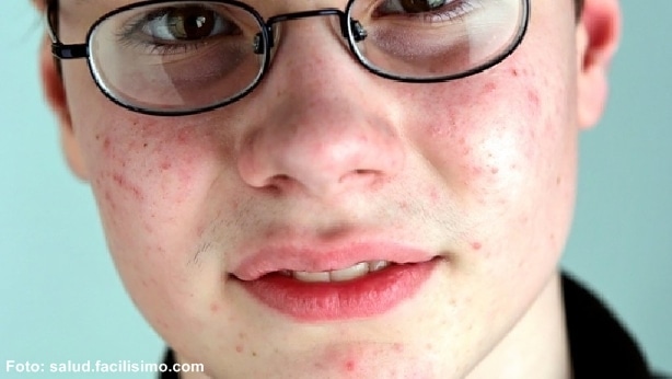 Formas de prevenir los granos